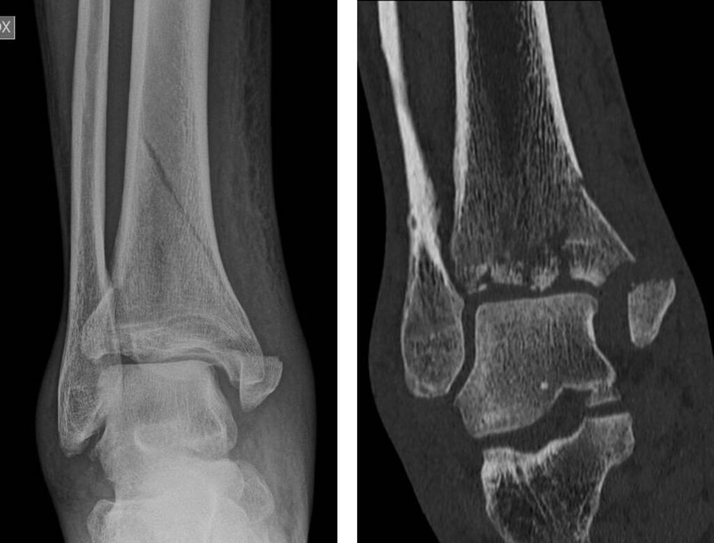 Pilon murtuma - Sandelin