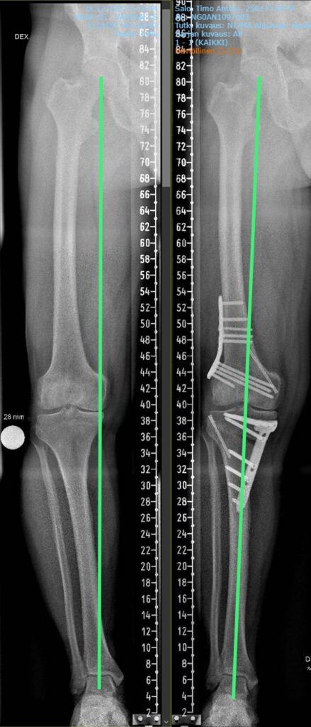 DLO (Double Level Osteotomy) - Sandelin
